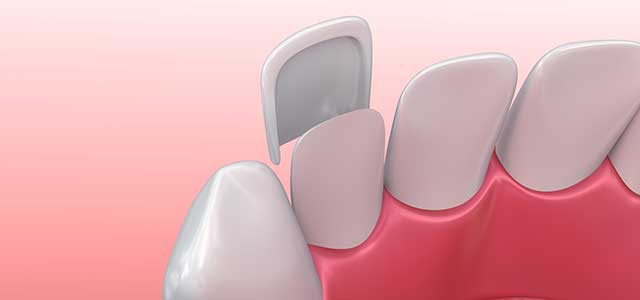 Pros And Cons Of Veneers And Are They Worth It